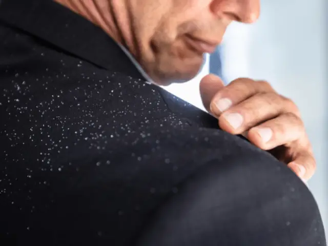 Bald Dandruff: Does it Exist? How to Avoid Shaved Head Flakes ...